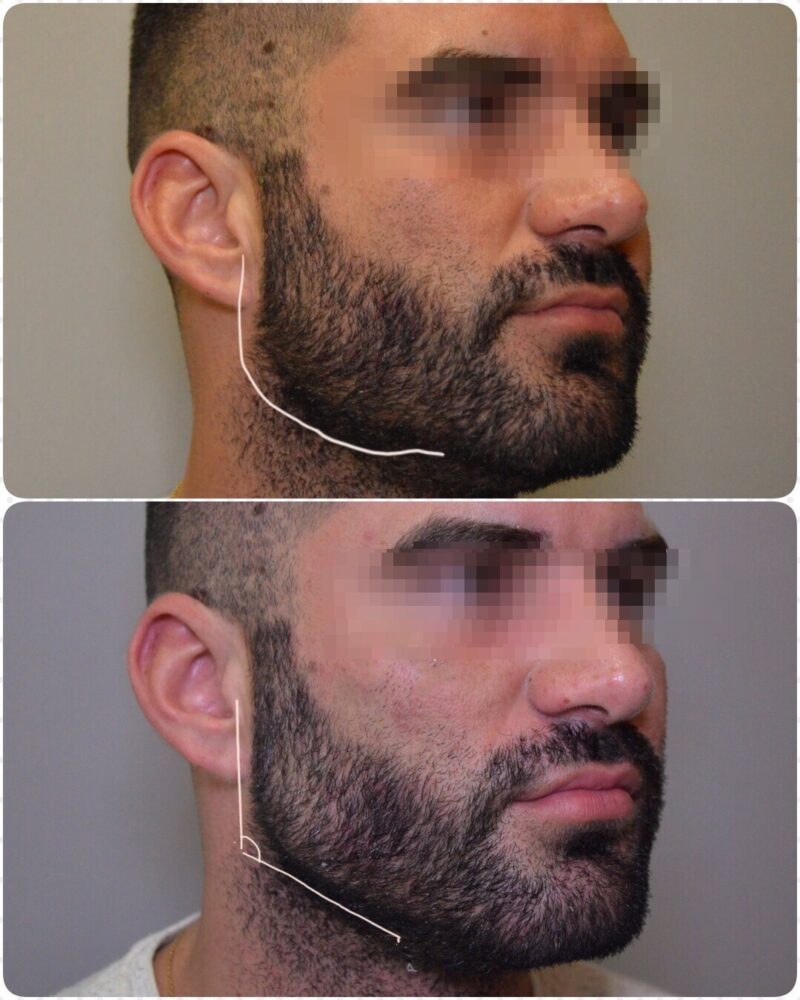 Masculinización Facial sin cirugía – Dr Edward Serrano